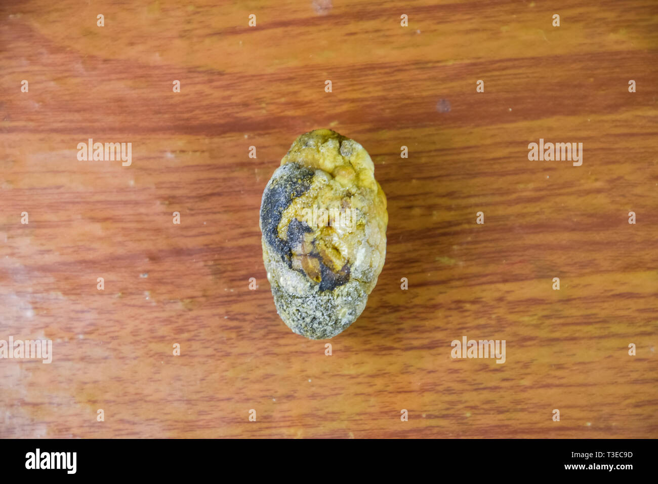 Large gallstone, Gall bladder stone. The result of gallstones. A ...