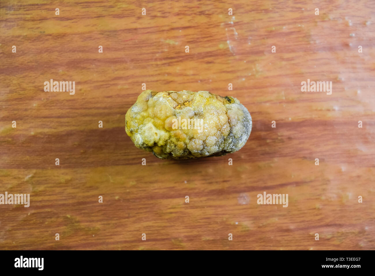 Large gallstone, Gall bladder stone. The result of gallstones. A ...