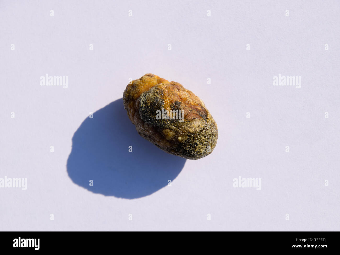 Stone of the gallbladder. The result of gallstones. A calculus of ...