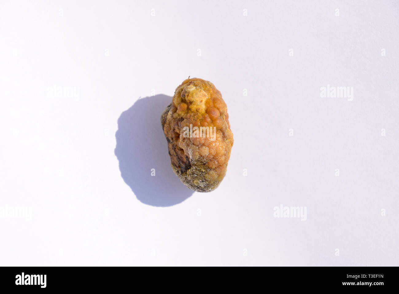 Stone of the gallbladder. The result of gallstones. A calculus of ...
