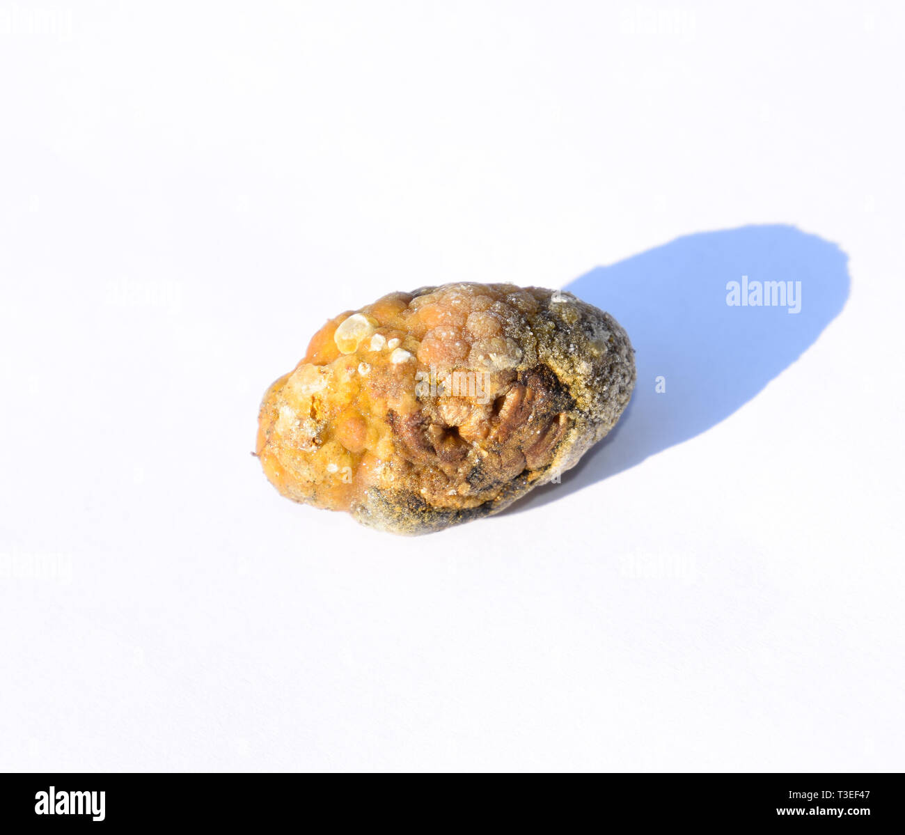 Stone of the gallbladder. The result of gallstones. A calculus of ...