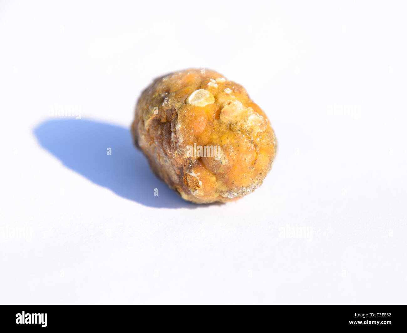 Stone of the gallbladder. The result of gallstones. A calculus of ...