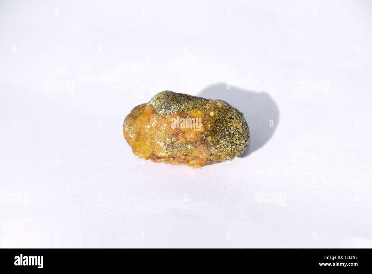 Stone of the gallbladder. The result of gallstones. A calculus of ...