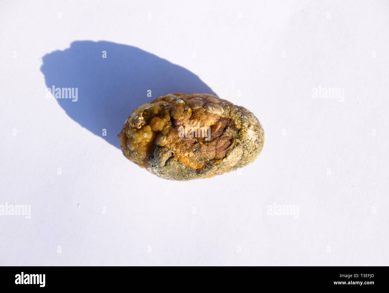 Stone of the gallbladder. The result of gallstones. A calculus of ...