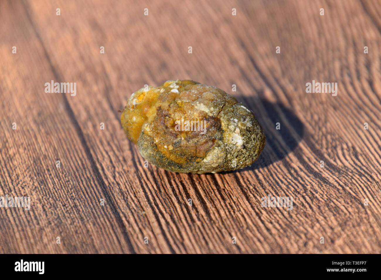 Stone of the gallbladder. The result of gallstones. A calculus of ...