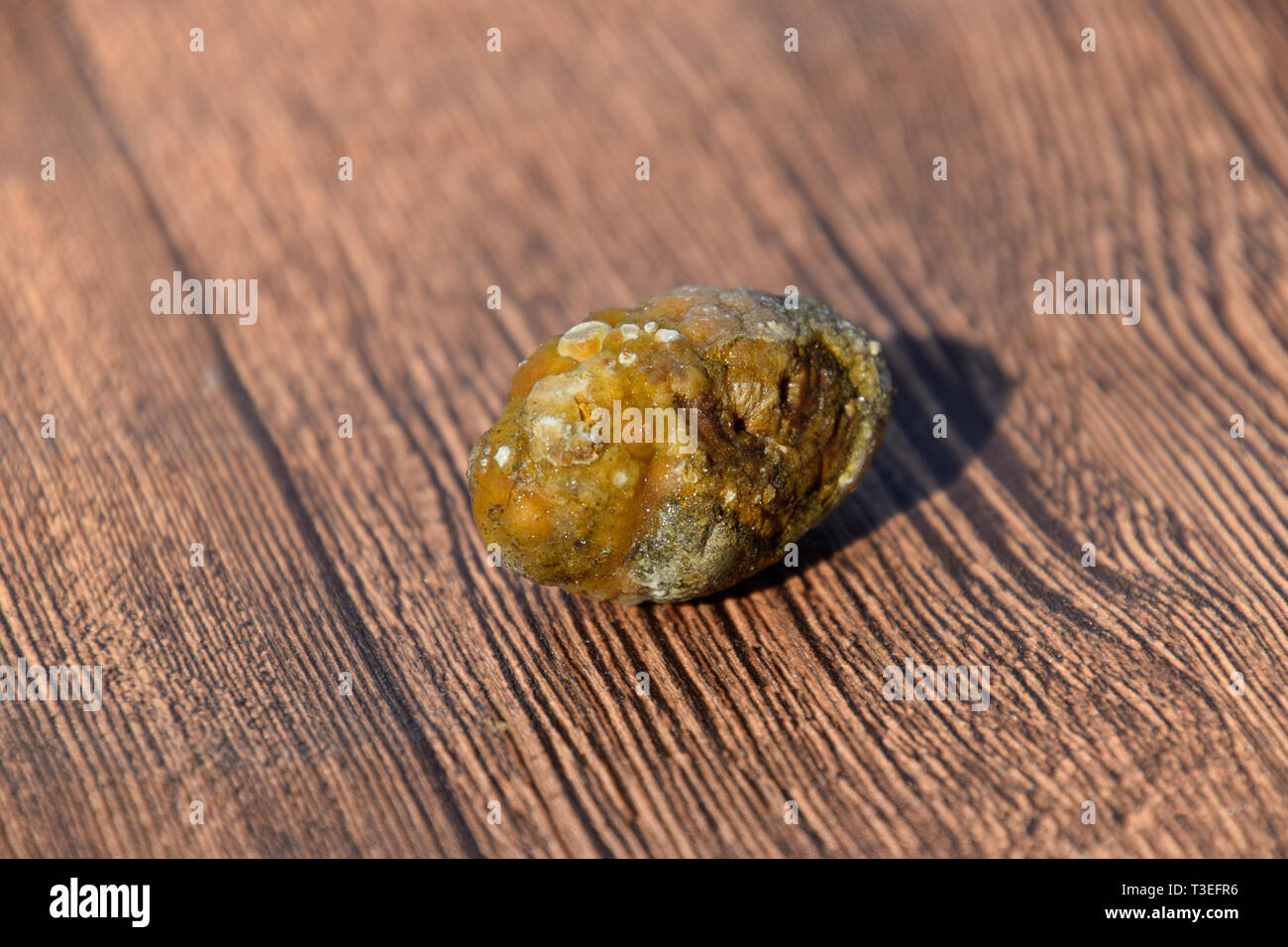 Stone of the gallbladder. The result of gallstones. A calculus of ...