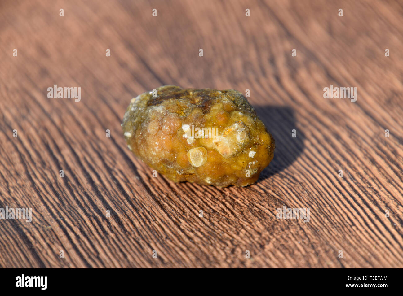 Stone of the gallbladder. The result of gallstones. A calculus of ...