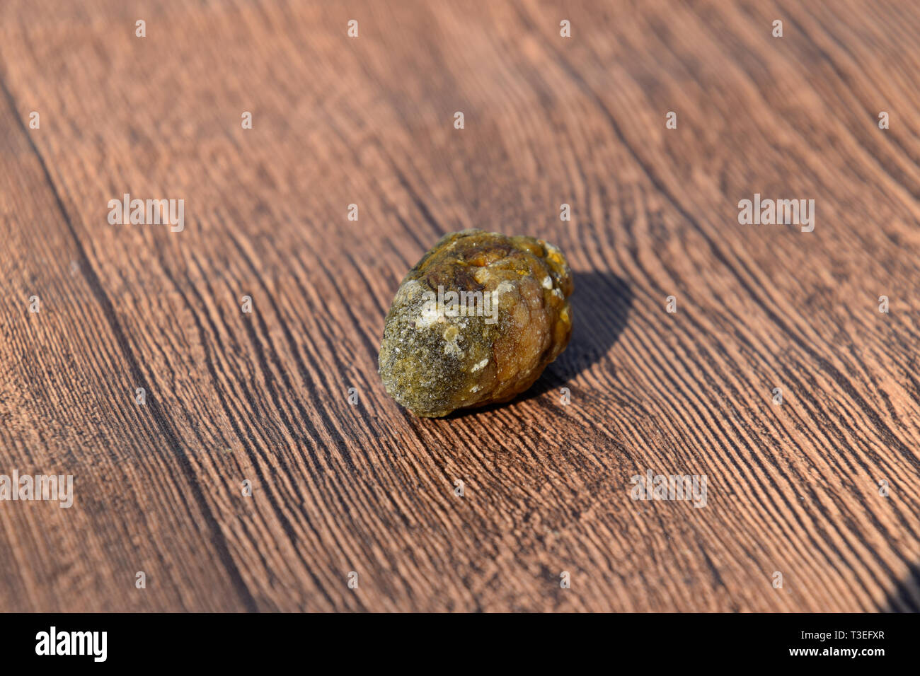 Stone of the gallbladder. The result of gallstones. A calculus of ...