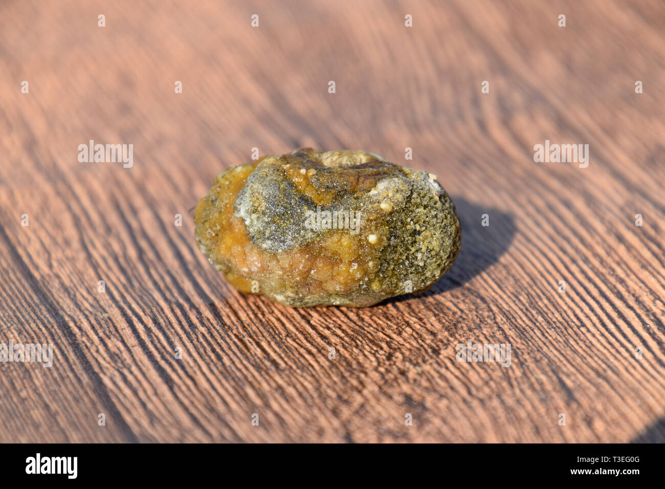 Stone of the gallbladder. The result of gallstones. A calculus of ...