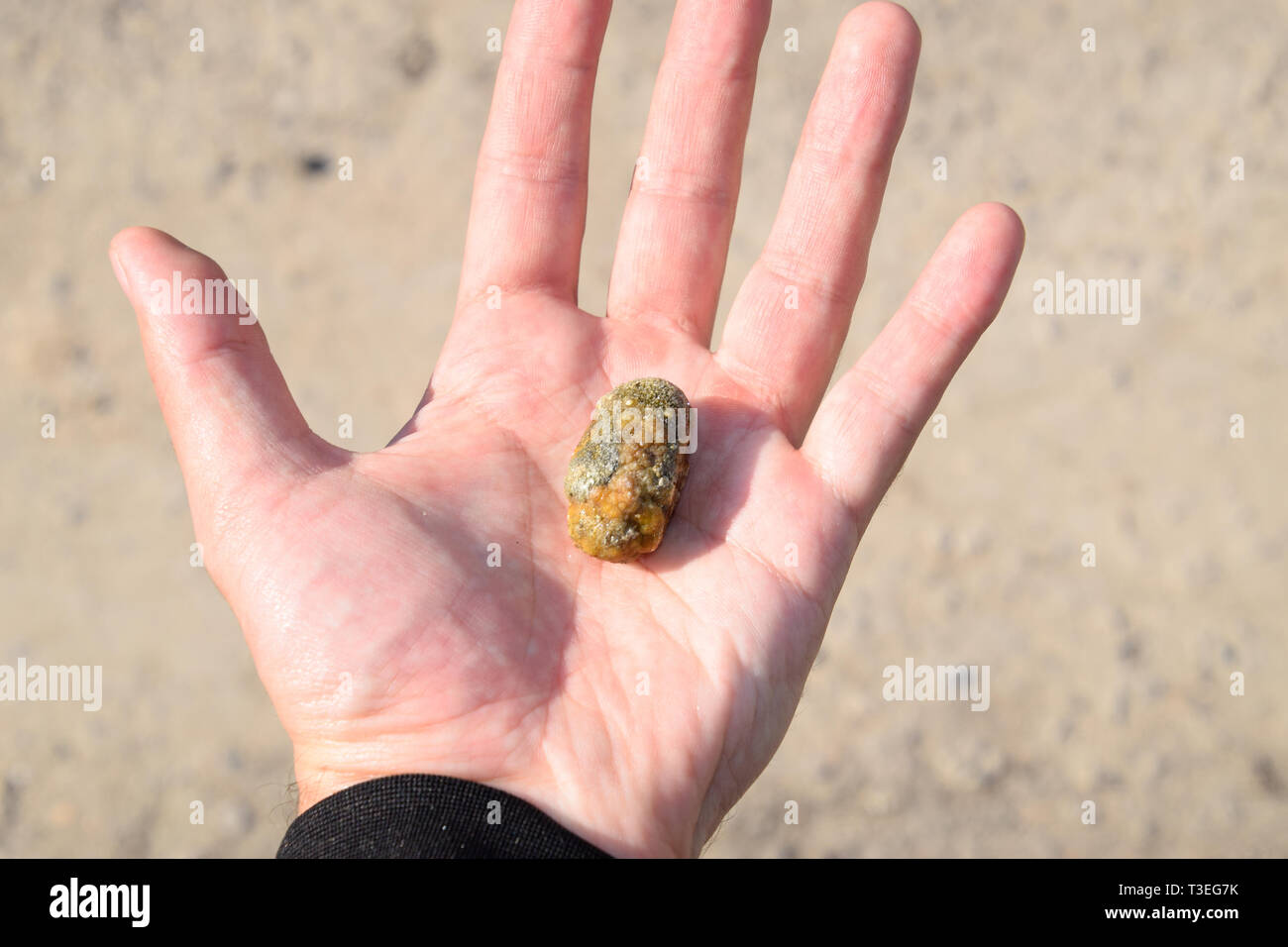 Gallstone in hand, Gall bladder stone. The result of gallstones ...
