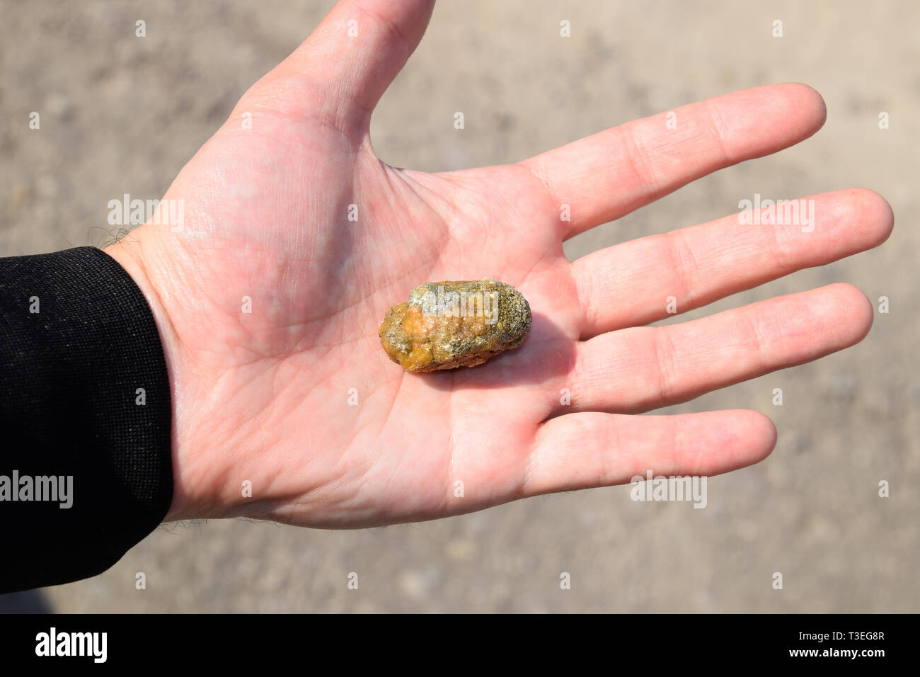 Gallstone in hand, Gall bladder stone. The result of gallstones ...