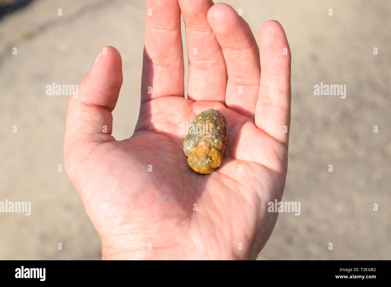 Gallstone in hand, Gall bladder stone. The result of gallstones ...