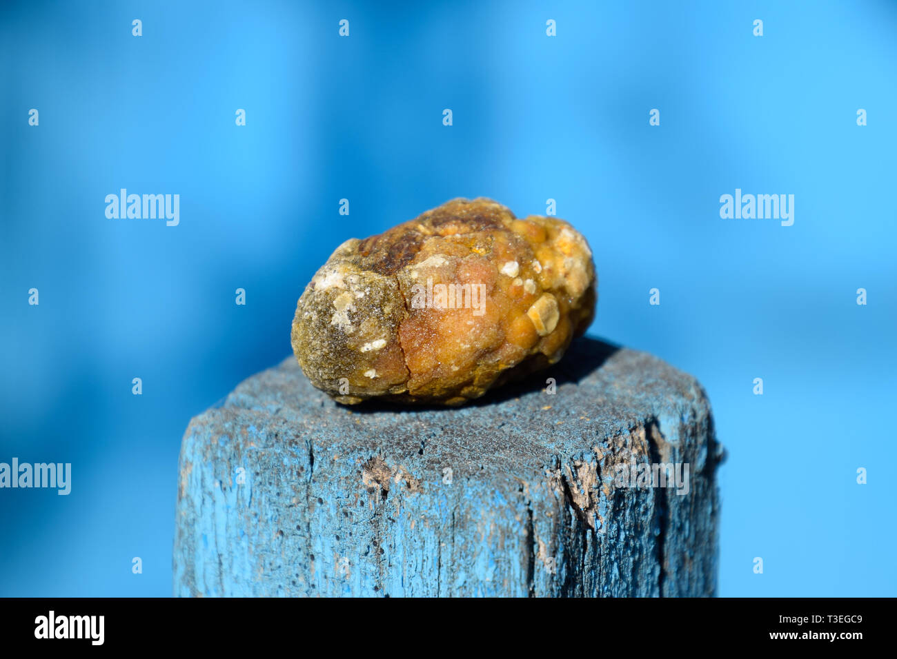 Human gallbladder anatomy stone hi-res stock photography and images - Alamy