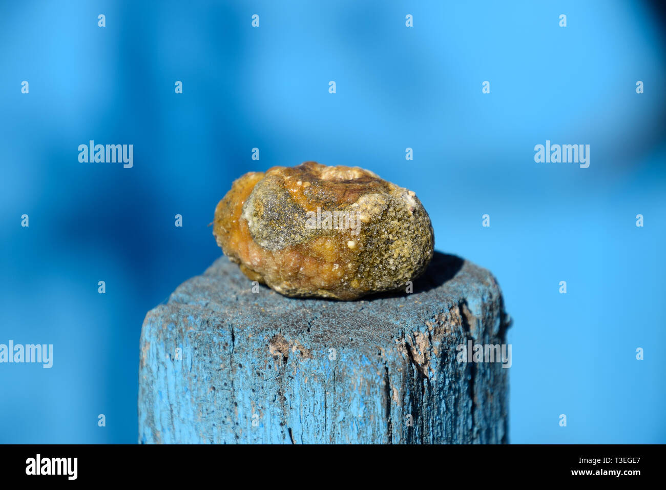 Gall bladder stone. The result of gallstones. Calculus of heterogeneous ...