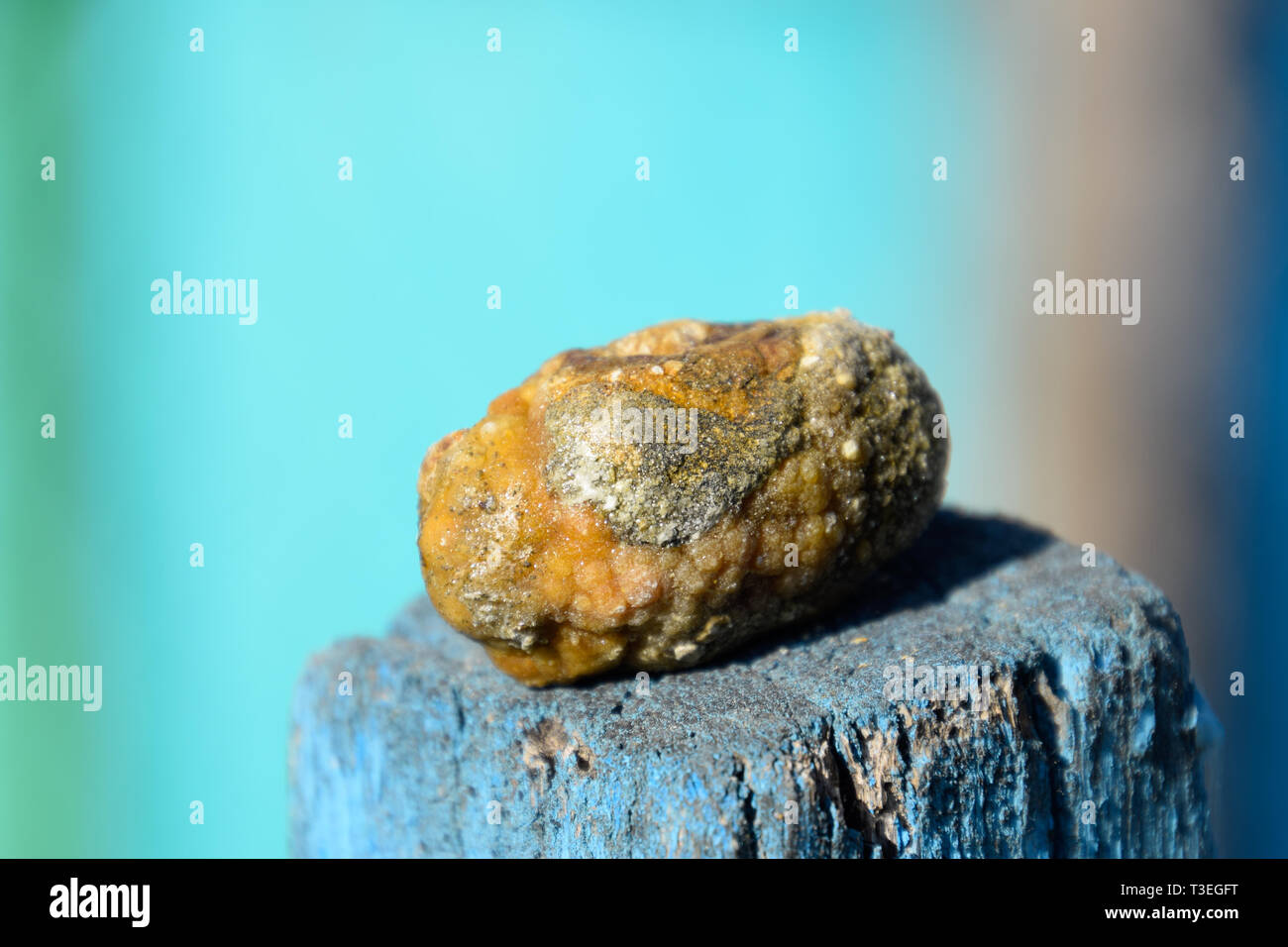 Gall bladder stone. The result of gallstones. Calculus of heterogeneous ...