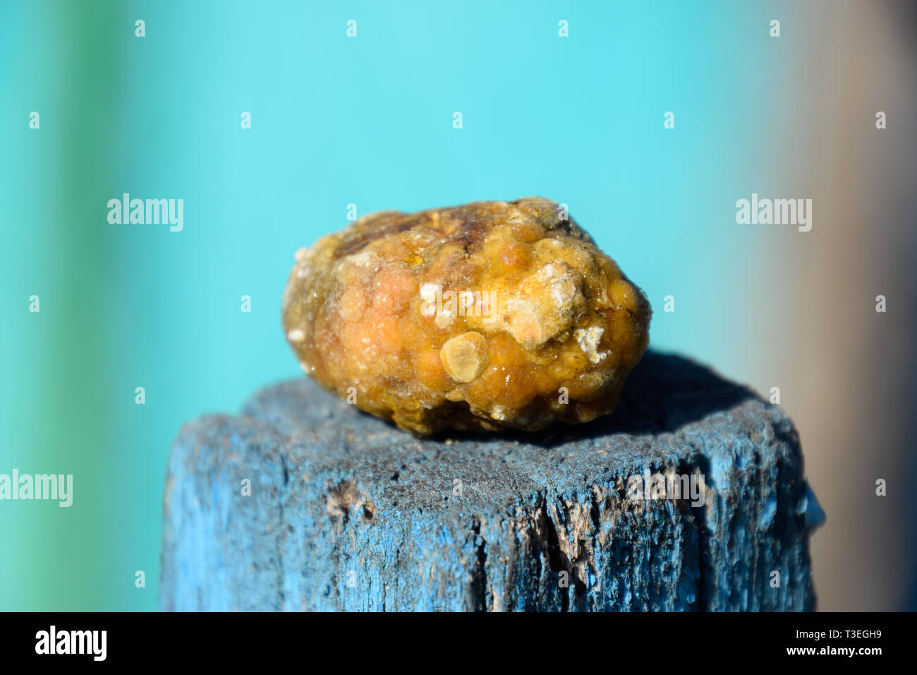 Gall bladder stone. The result of gallstones. Calculus of heterogeneous ...