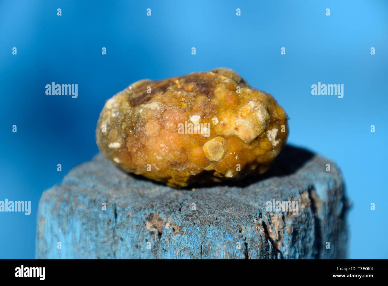 Gall bladder stone. The result of gallstones. Calculus of heterogeneous ...