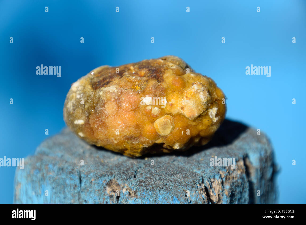Gall bladder stone. The result of gallstones. Calculus of heterogeneous ...