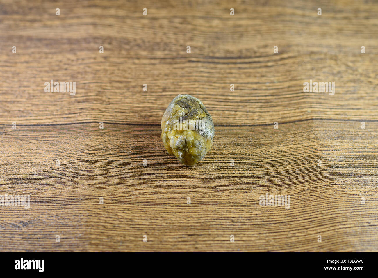 Large gallstone, Gall bladder stone. The result of gallstones. Calculus ...