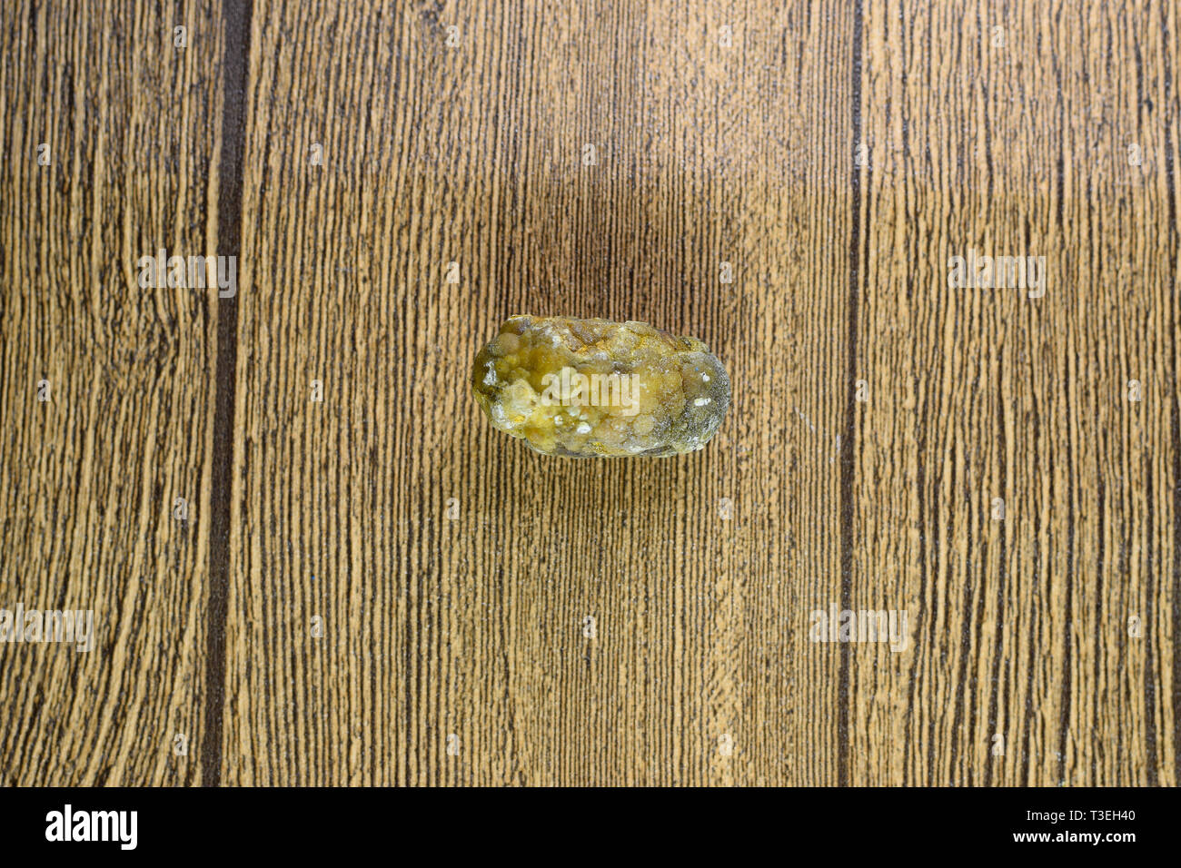 Large gallstone, Gall bladder stone. The result of gallstones. Calculus ...