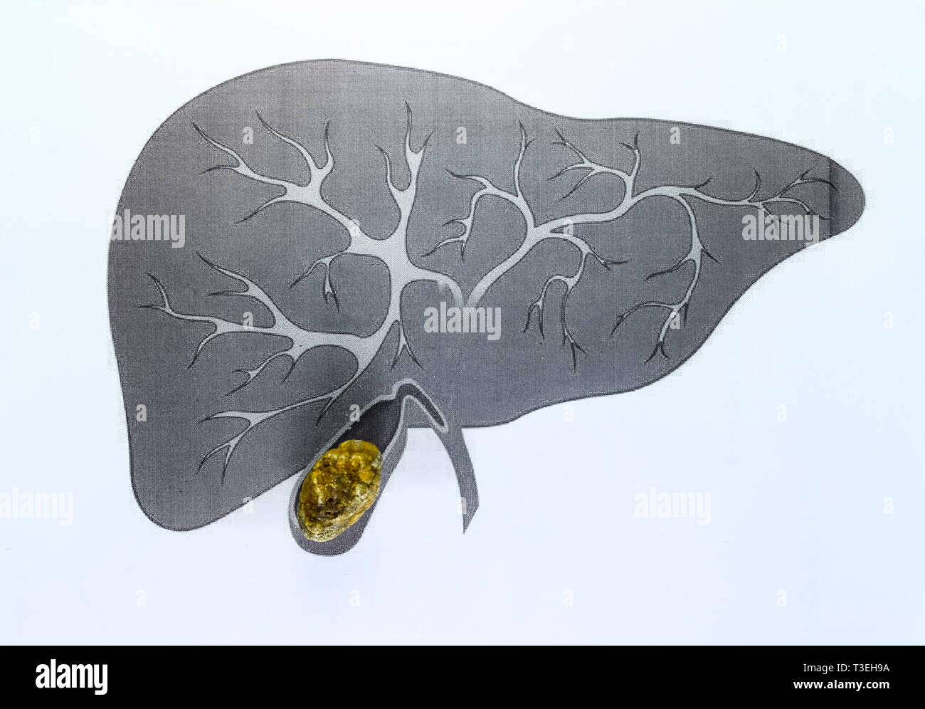 Gall bladder stone, schematic depiction, large-sized Gallstone, Result ...