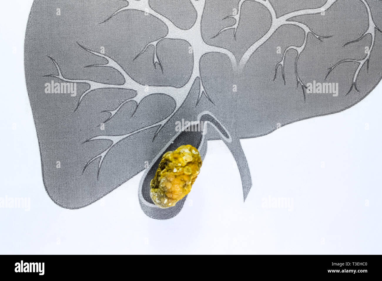 Gall bladder stone, schematic depiction, large-sized Gallstone, Result ...