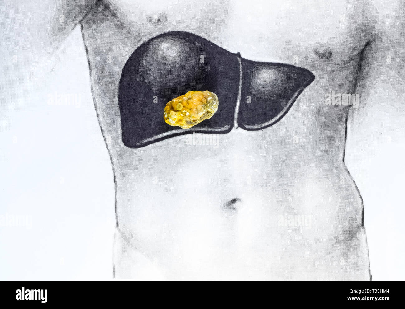 stone in the liver, a schematic image, a large gallstone, the result of ...