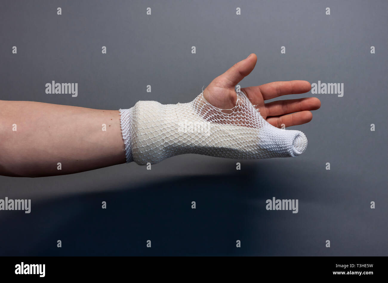 Arm cast hi-res stock photography and images - Alamy