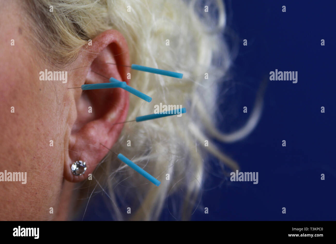 Close up of human female ear with blue needles: Ear acupuncture as a ...
