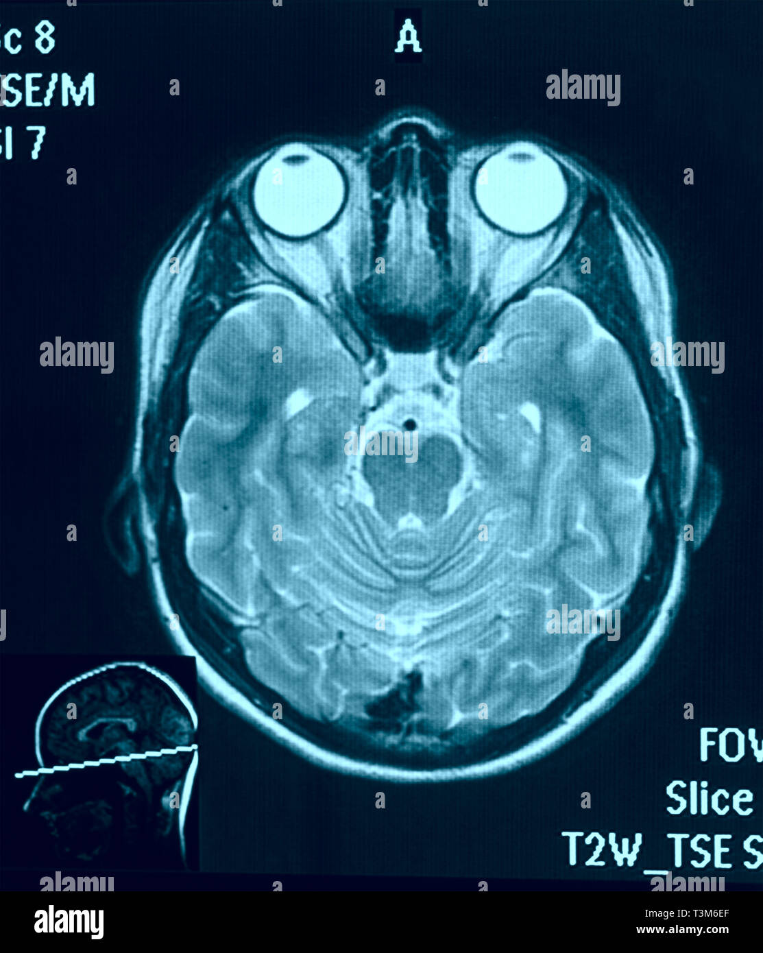 Mri scan hi-res stock photography and images - Alamy