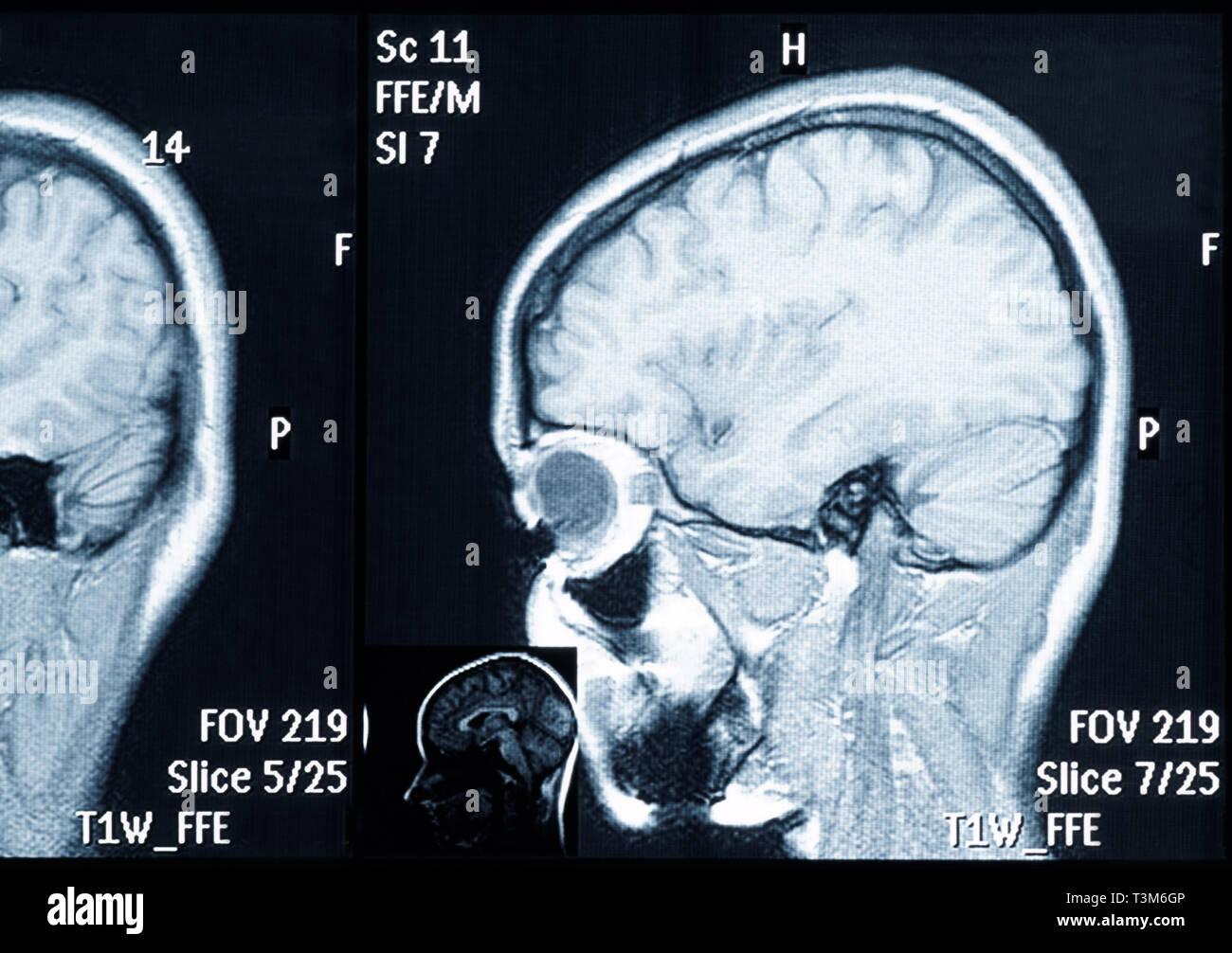 Real human brain anatomy hi-res stock photography and images - Alamy
