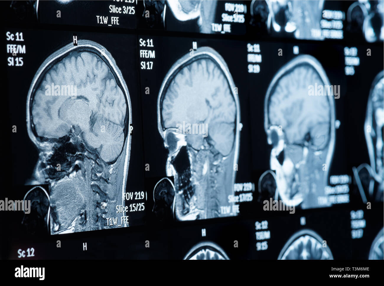 Head MRI scan, personal data removed Stock Photo - Alamy