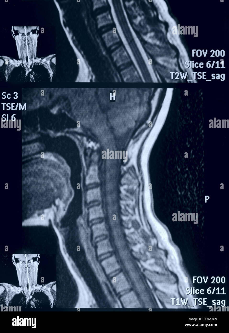 Mri neck hi-res stock photography and images - Alamy