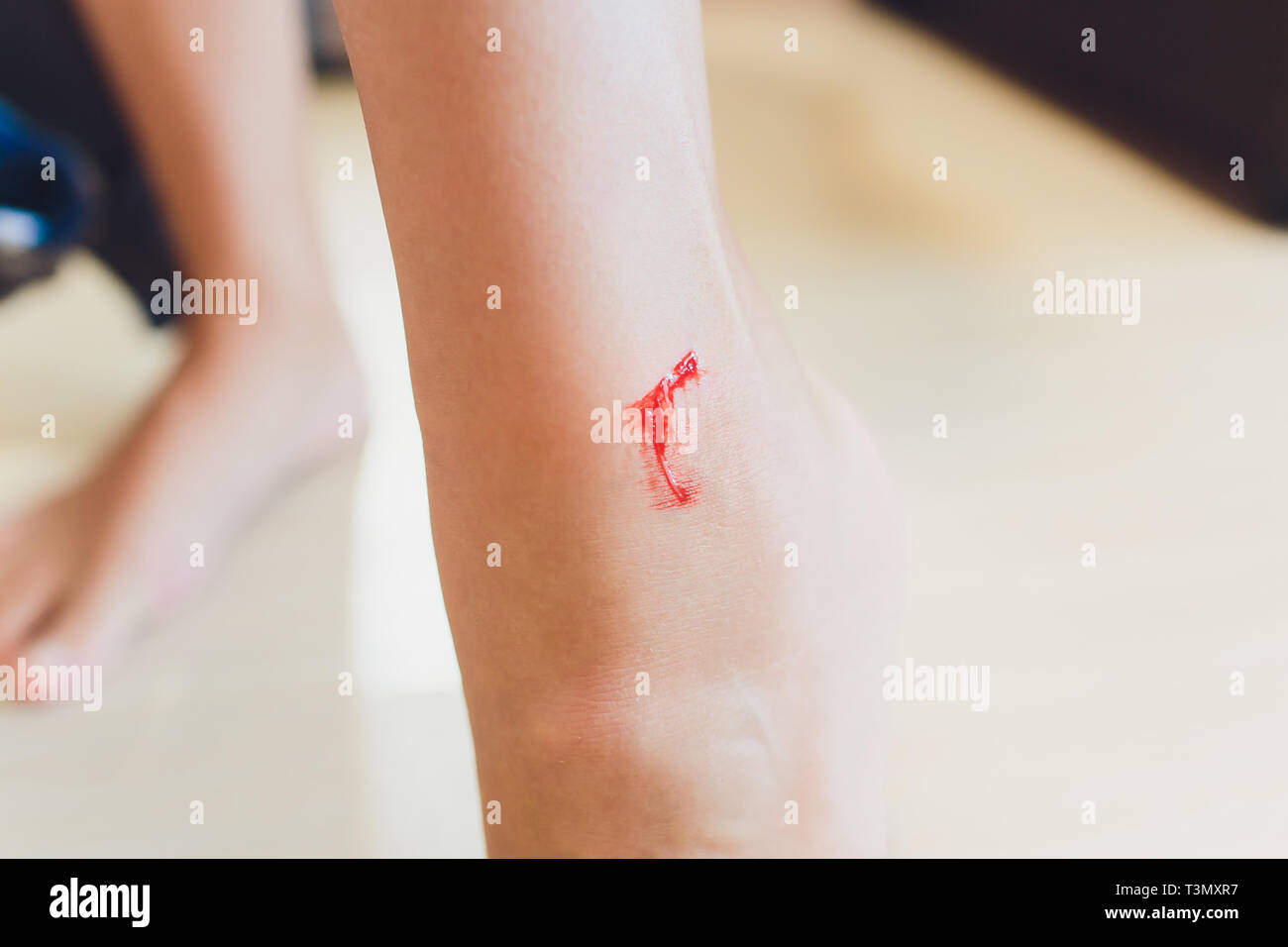 Wound Bleeding Stock Photos & Wound Bleeding Stock Images - Alamy
