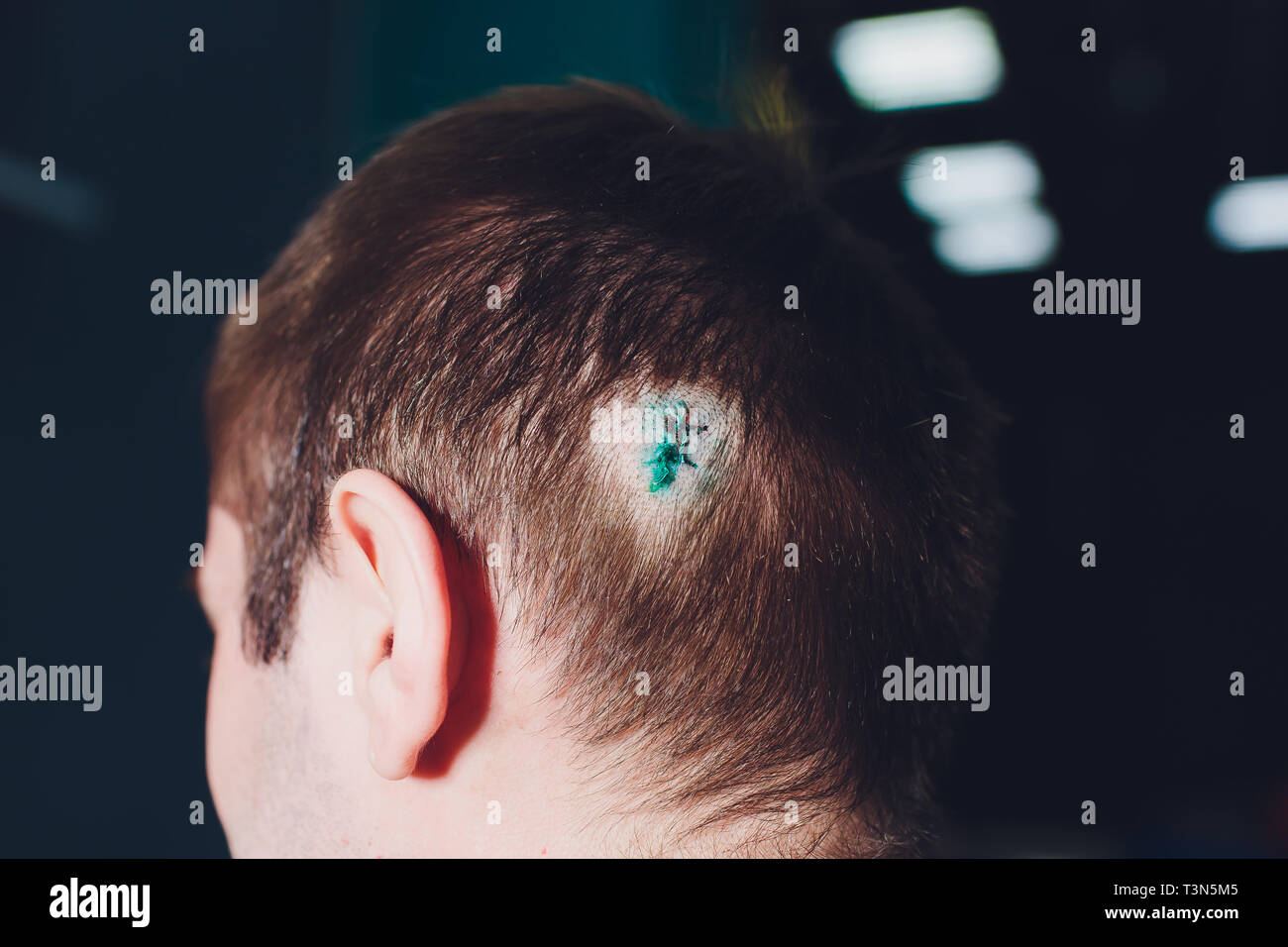 View of scars after skin surgery on the head Stock Photo - Alamy