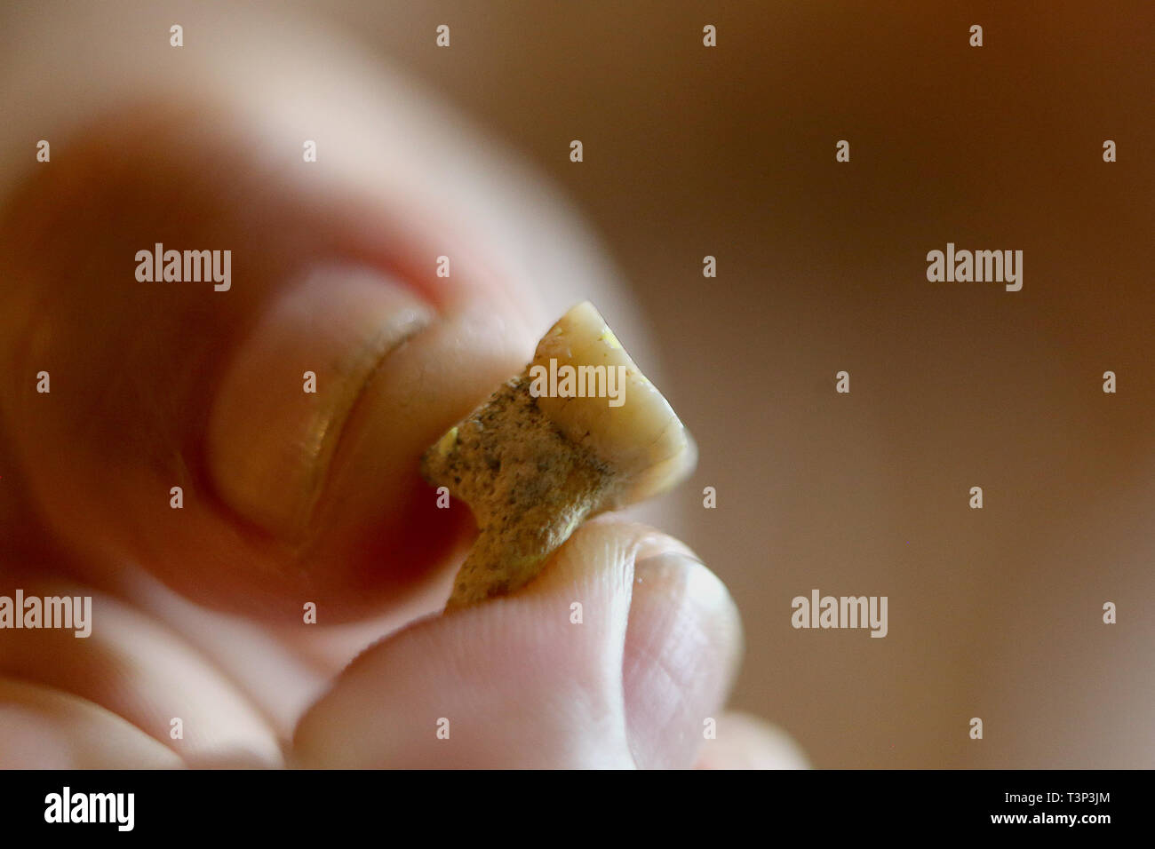 Molar tooth hi-res stock photography and images - Alamy