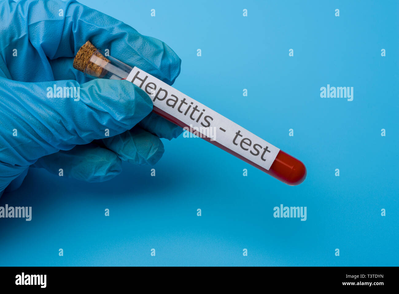 Hepatitis test, Blood in the test Tube. The concept of Medicine and ...