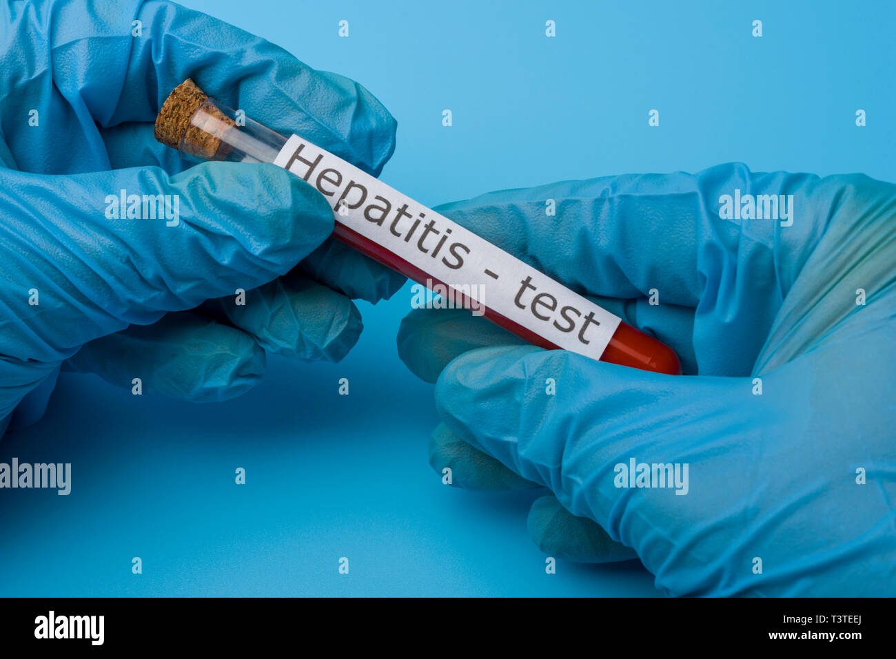 Hepatitis test, Blood in the test Tube. The concept of Medicine and ...