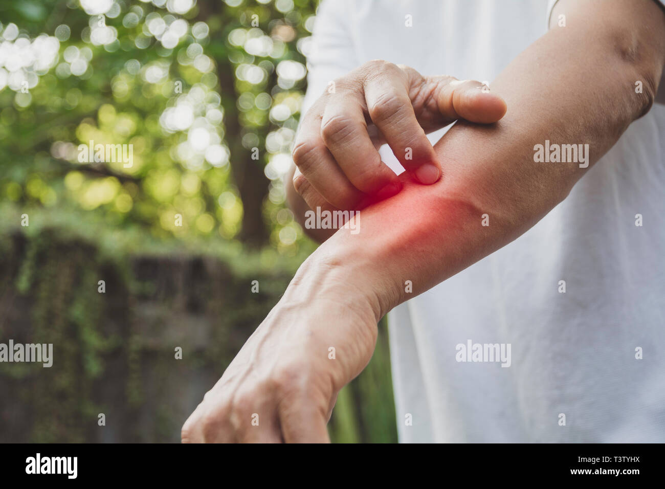 Wrist Rash High Resolution Stock Photography and Images - Alamy
