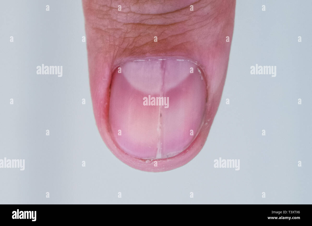 Forked nail on the thumb. Dilation of the nail, traumatic pathology ...