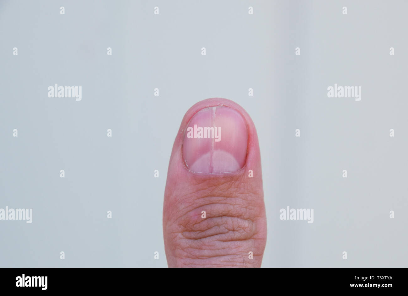 Forked nail on the thumb. Dilation of the nail, traumatic pathology ...