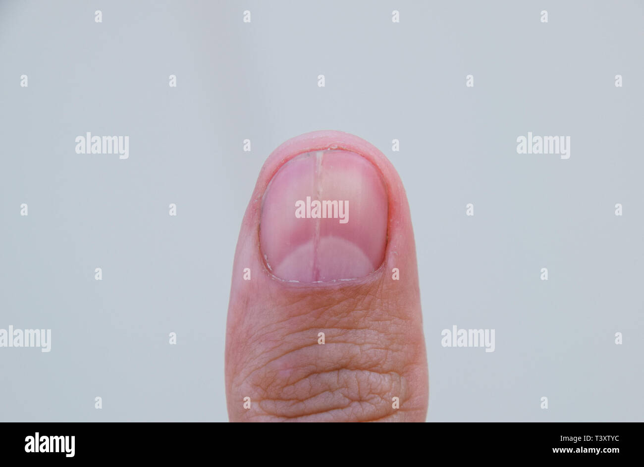 Forked nail on the thumb. Dilation of the nail, traumatic pathology ...