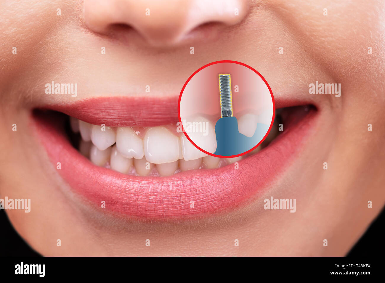 Close Up Of Woman's Teeth Highlighting Screw Of Tooth Implantation ...