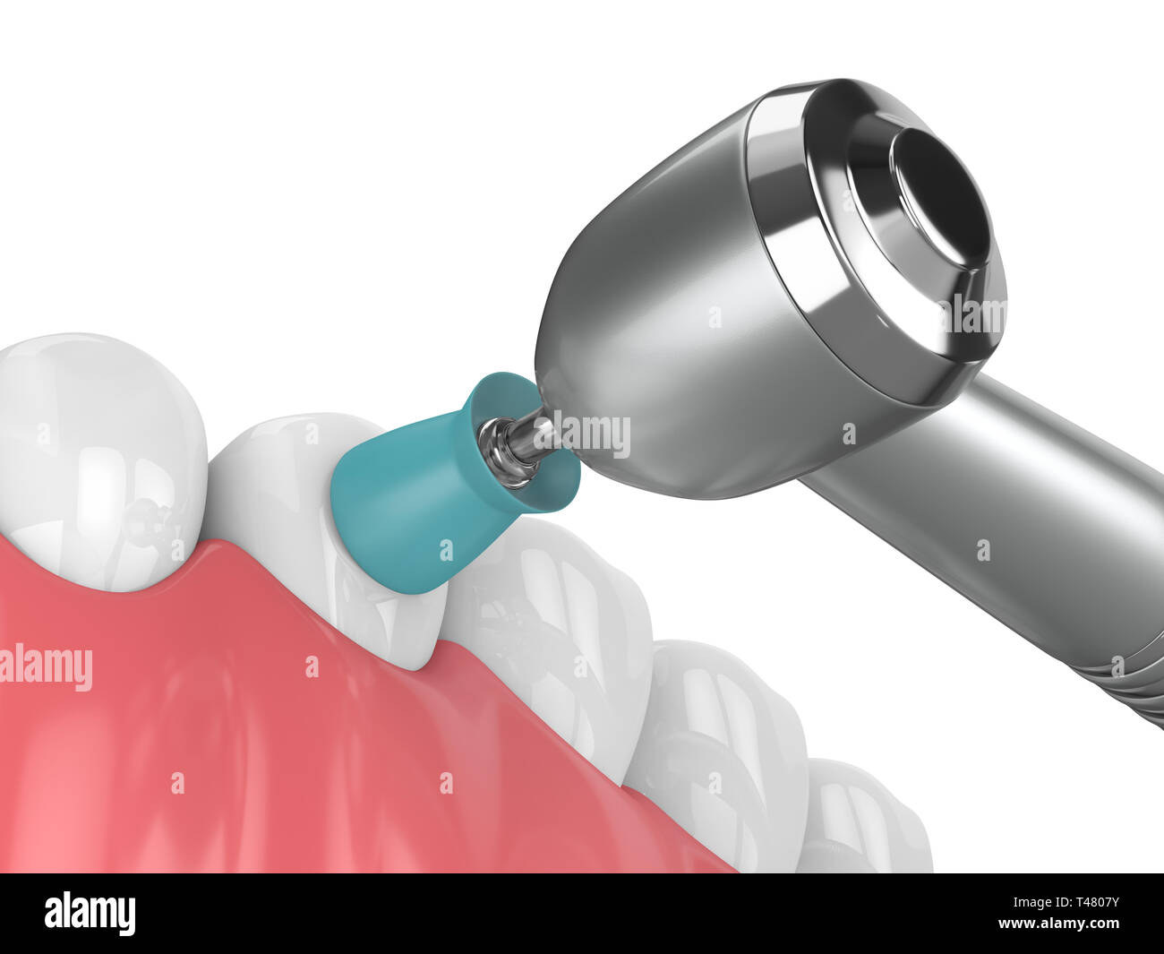 3d render of jaw with dental handpiece and polishing prophy cup. Dental ...