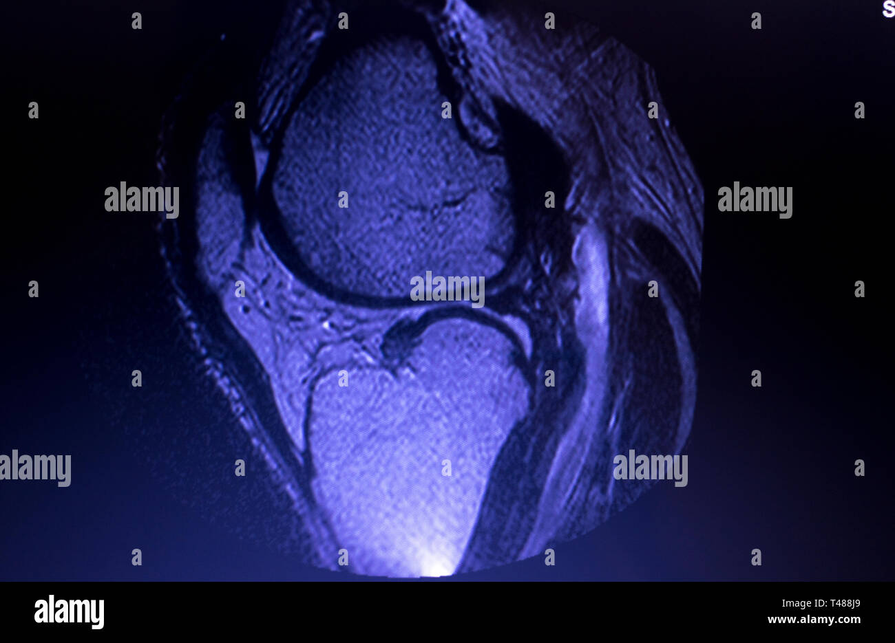 Magnetic resonance imaging MRI knee posterior horn medial meniscus tear ...