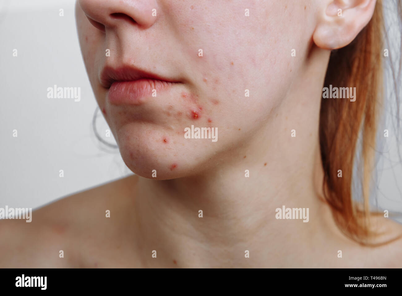 Young women with problematic skin and pimples on her face. Feamle ...