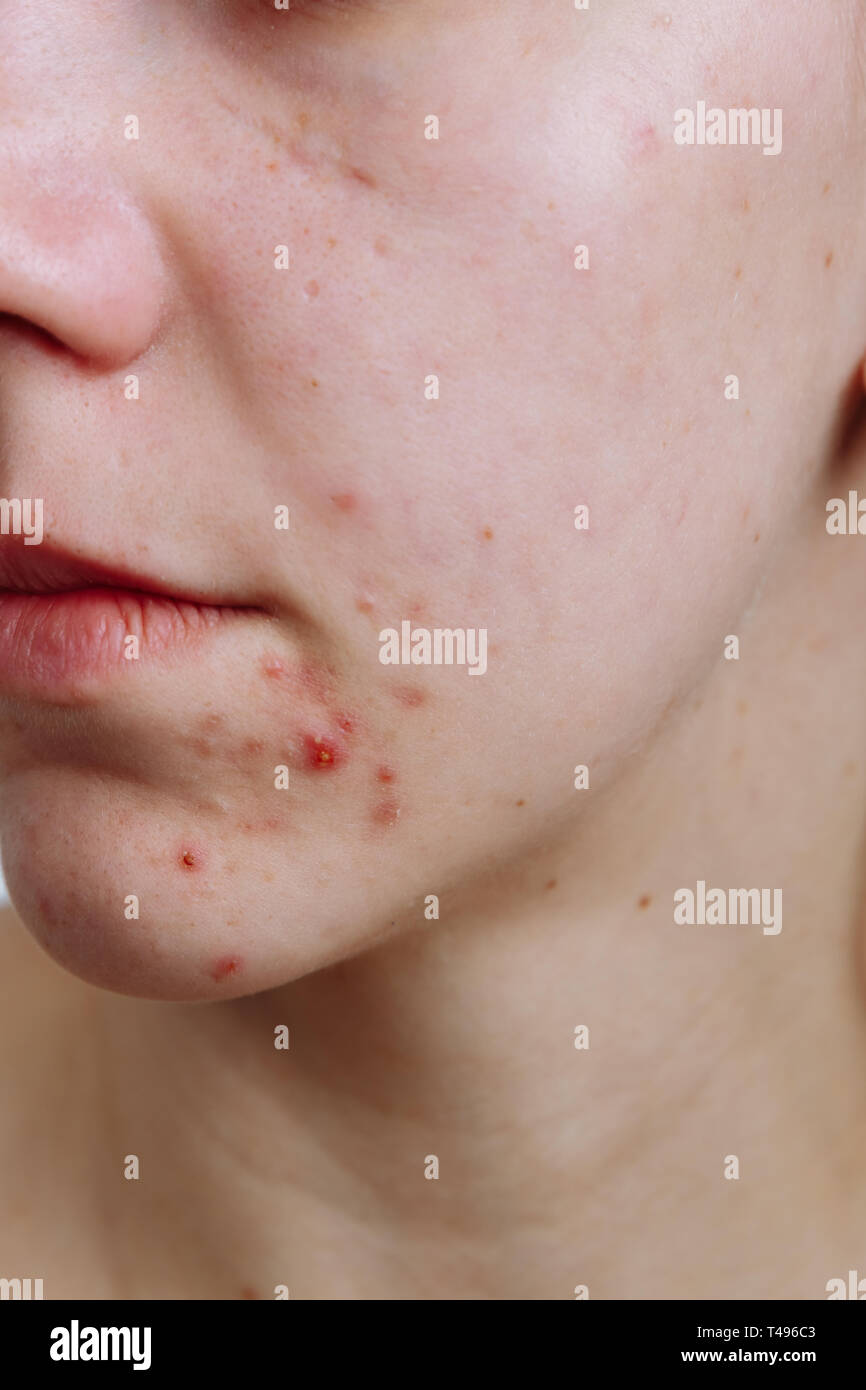 Young women with problematic skin and pimples on her face. Feamle ...