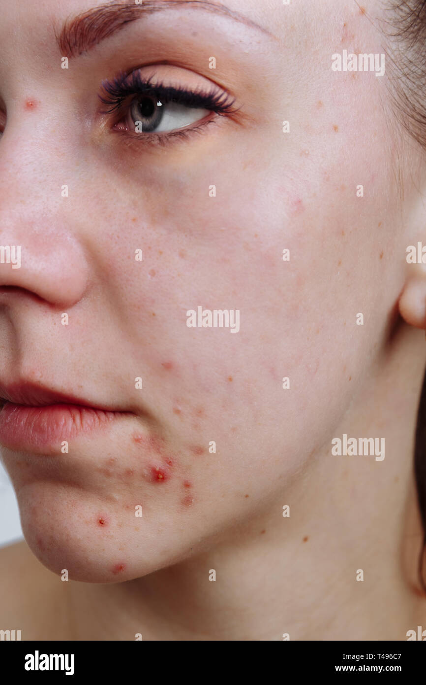 Young women with problematic skin and pimples on her face. Feamle ...