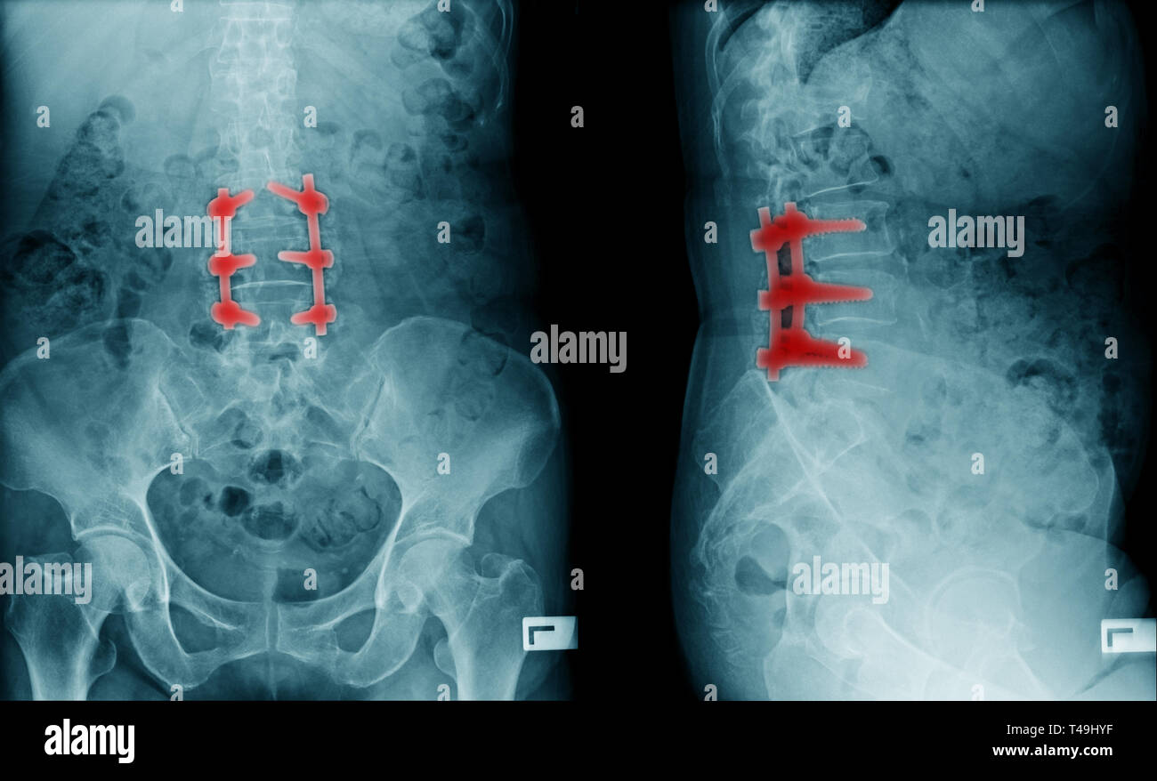 X ray normal lumbar spine hi-res stock photography and images - Alamy