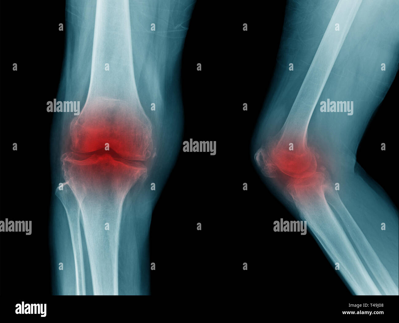 Knee crepitation hi-res stock photography and images - Alamy